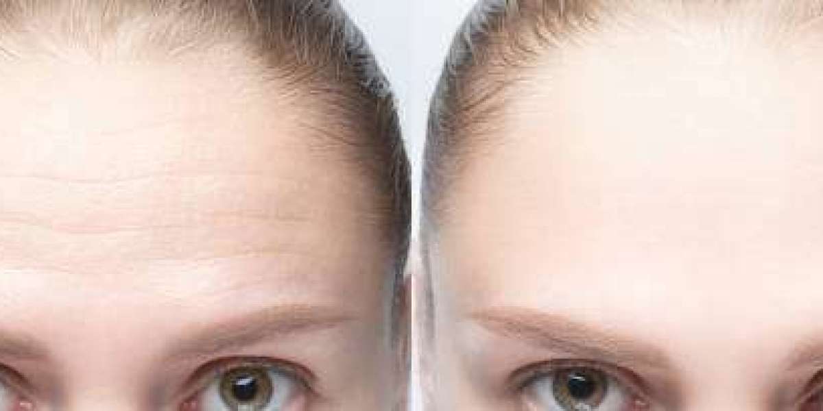 Forehead Lift Recovery Timeline in Riyadh: What to Expect